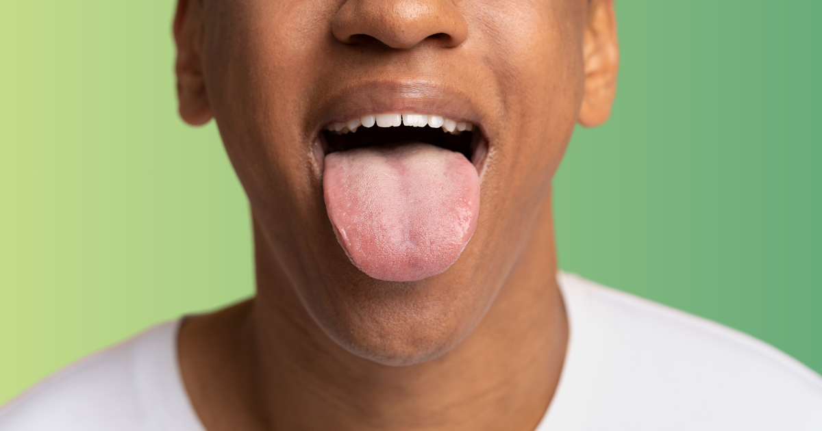 Saburra Lingual: entenda por que a língua fica branca - Orthoclin